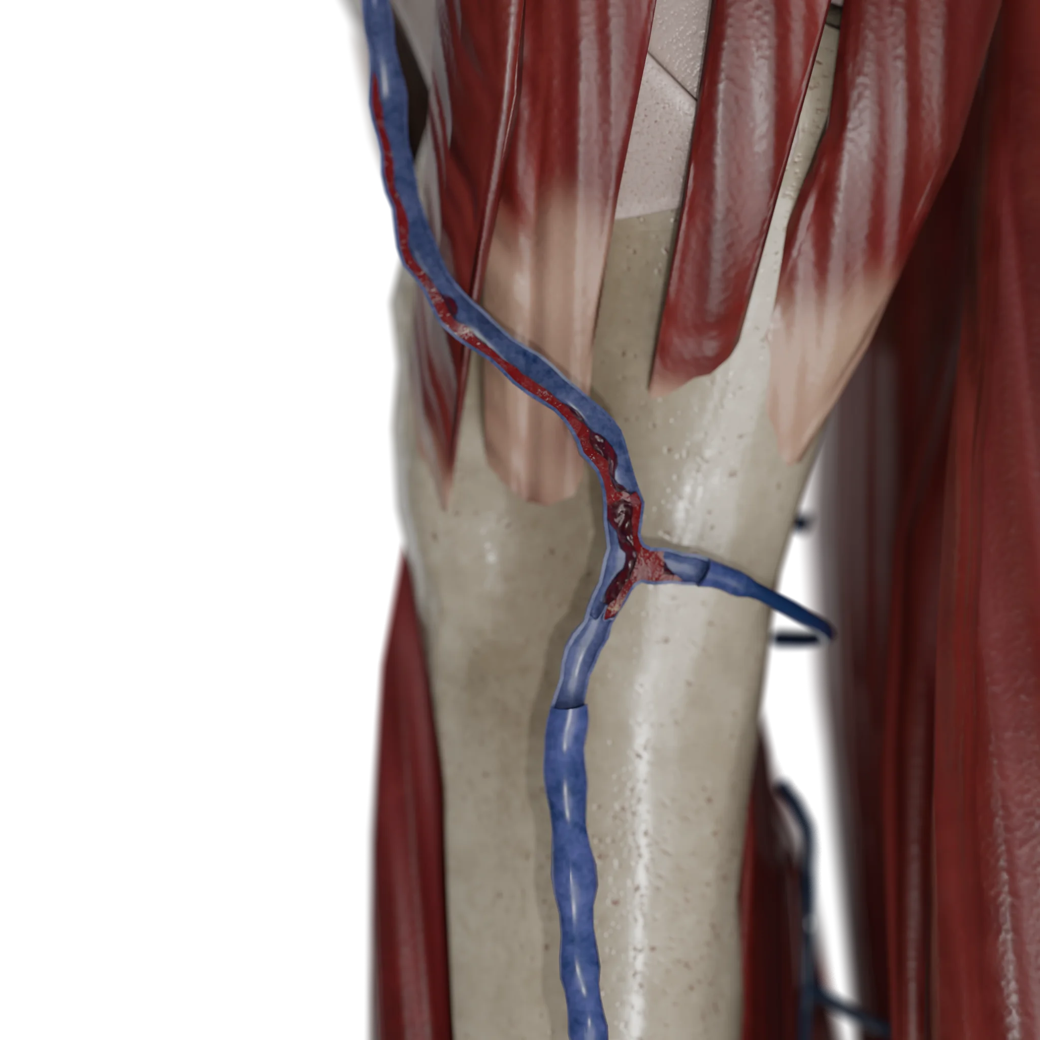 Thrombophlebitis: Symptome, Ursachen, Diagnostik und Therapie